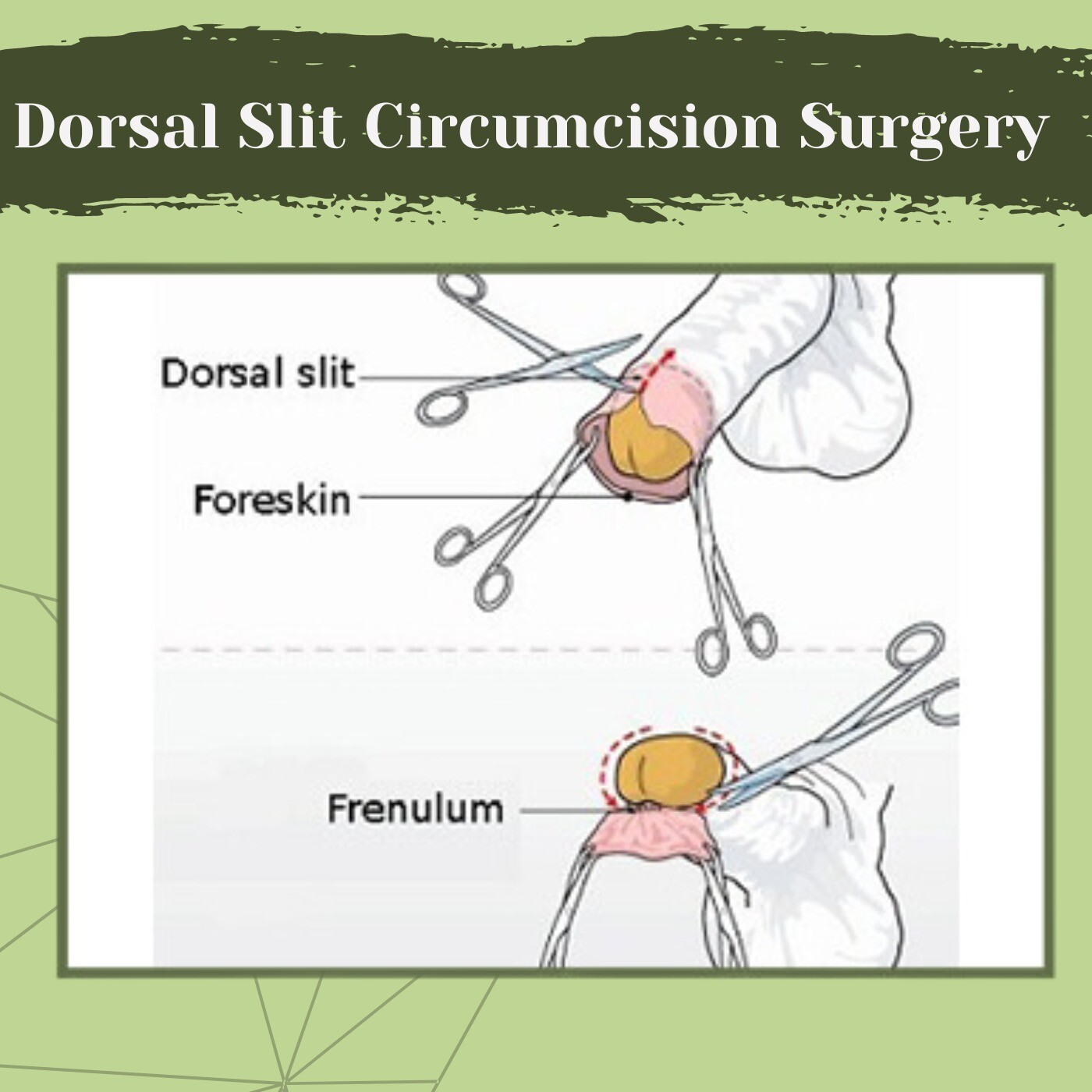 Paraphimosis Treatment Dorsal Slit